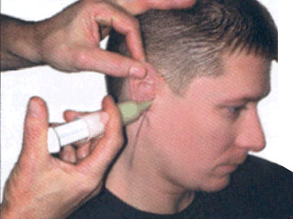 Impression Techniques - Great Lakes Earmold Lab